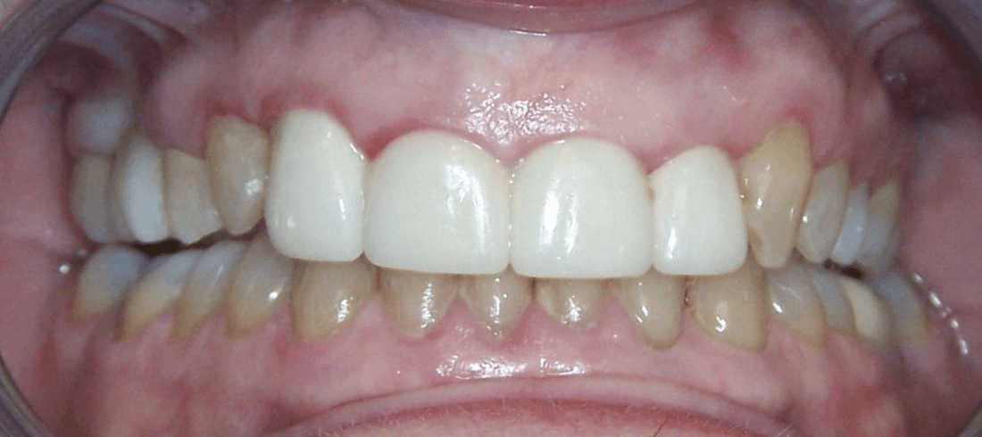 Crowns 1 Before & After Photos | Geneva IL